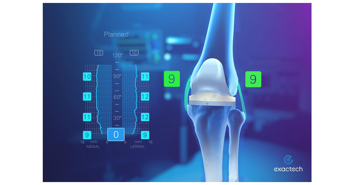 New Exactech Knee Research Demonstrates Ability to Achieve Balanced ...