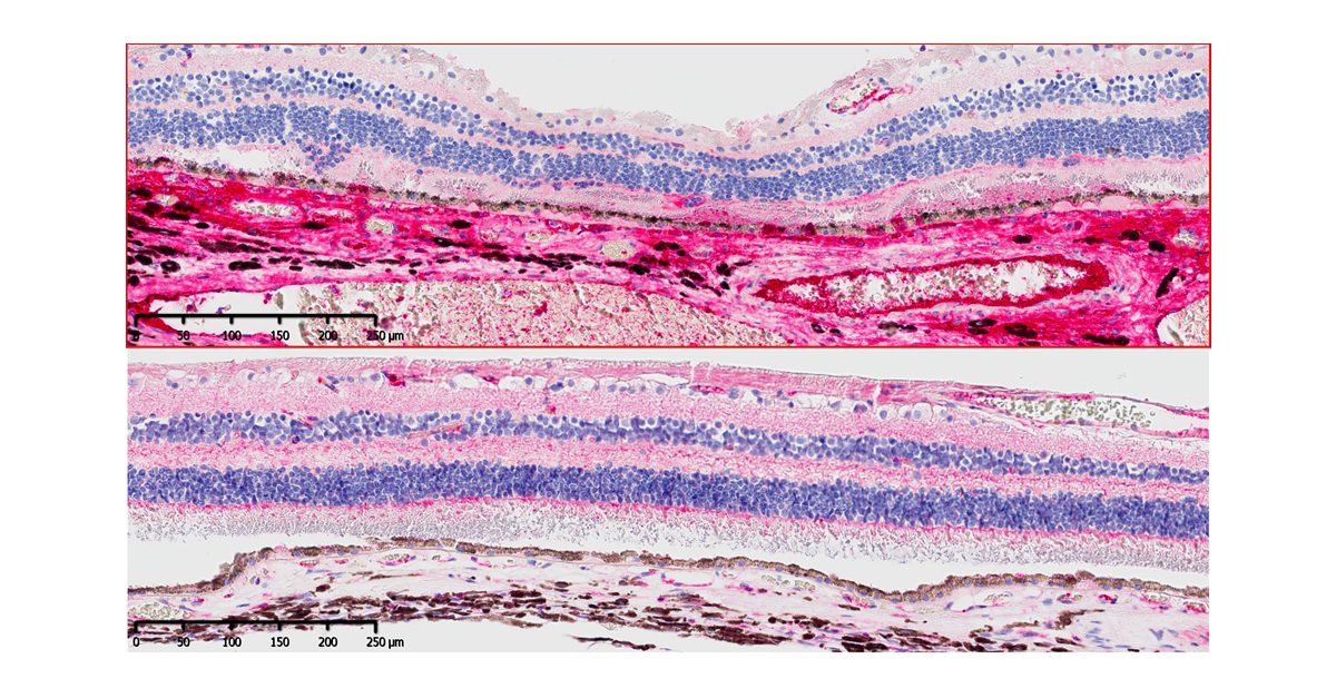 Therini Bio Raises $36M Series A Financing to Develop Fibrin-Targeted ...