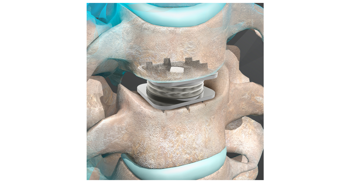 Orthofix Announces First Presentation of Seven-Year Outcome Data for ...