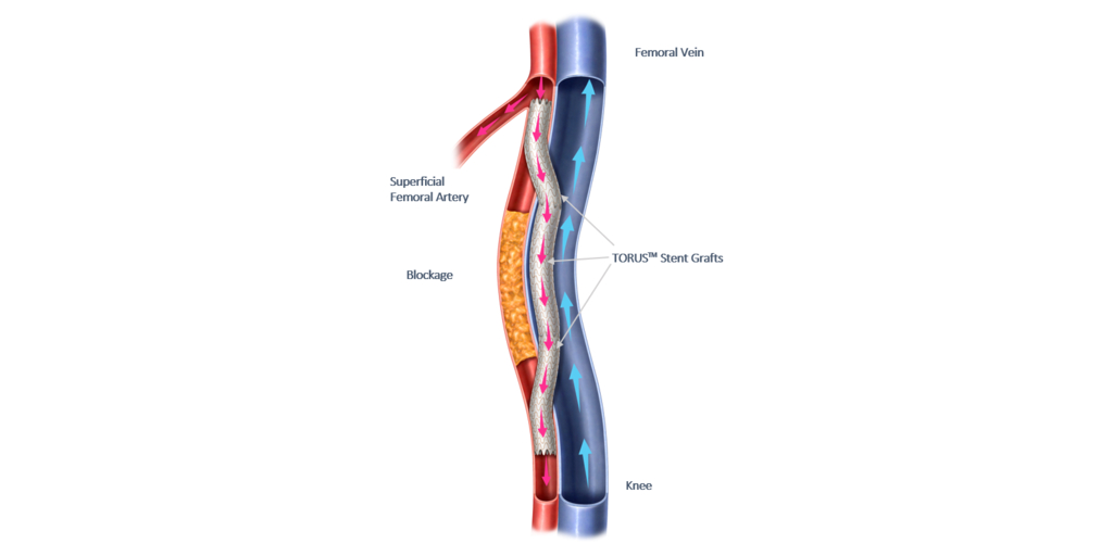 Endologix Receives FDA Approval of the DETOUR™ System to Treat Long ...