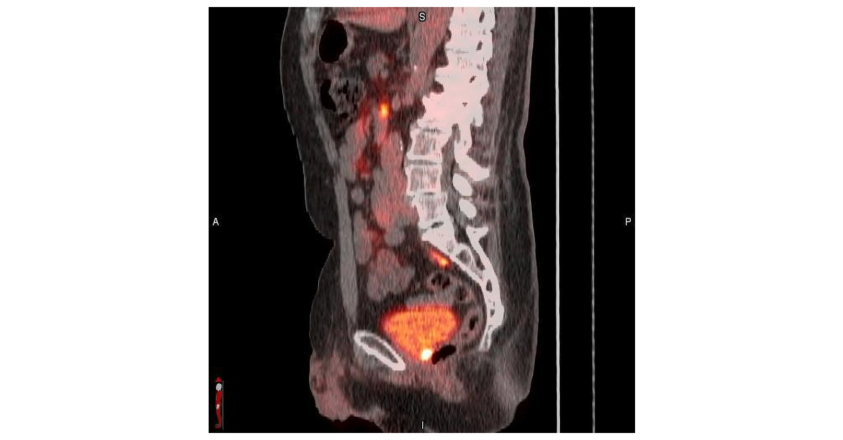New Data on POSLUMA® (Flotufolastat F 18) in Patients with Suspected ...