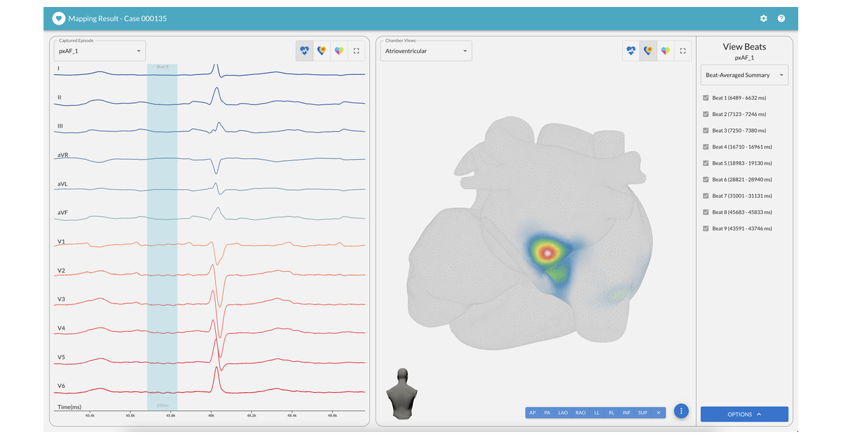 Vektor Medical Announces New CPT Code for Novel Noninvasive Arrhythmia Analysis Using vMap ...