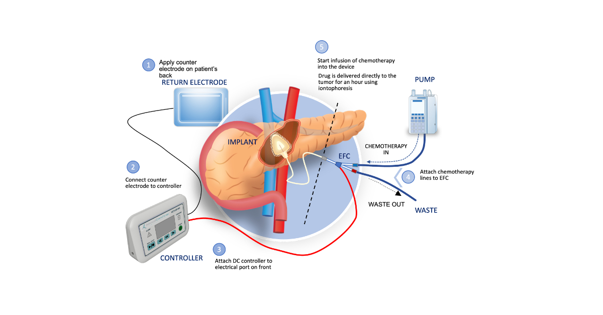 Focal Medical Complete Development of a Therapeutic System to Deliver ...