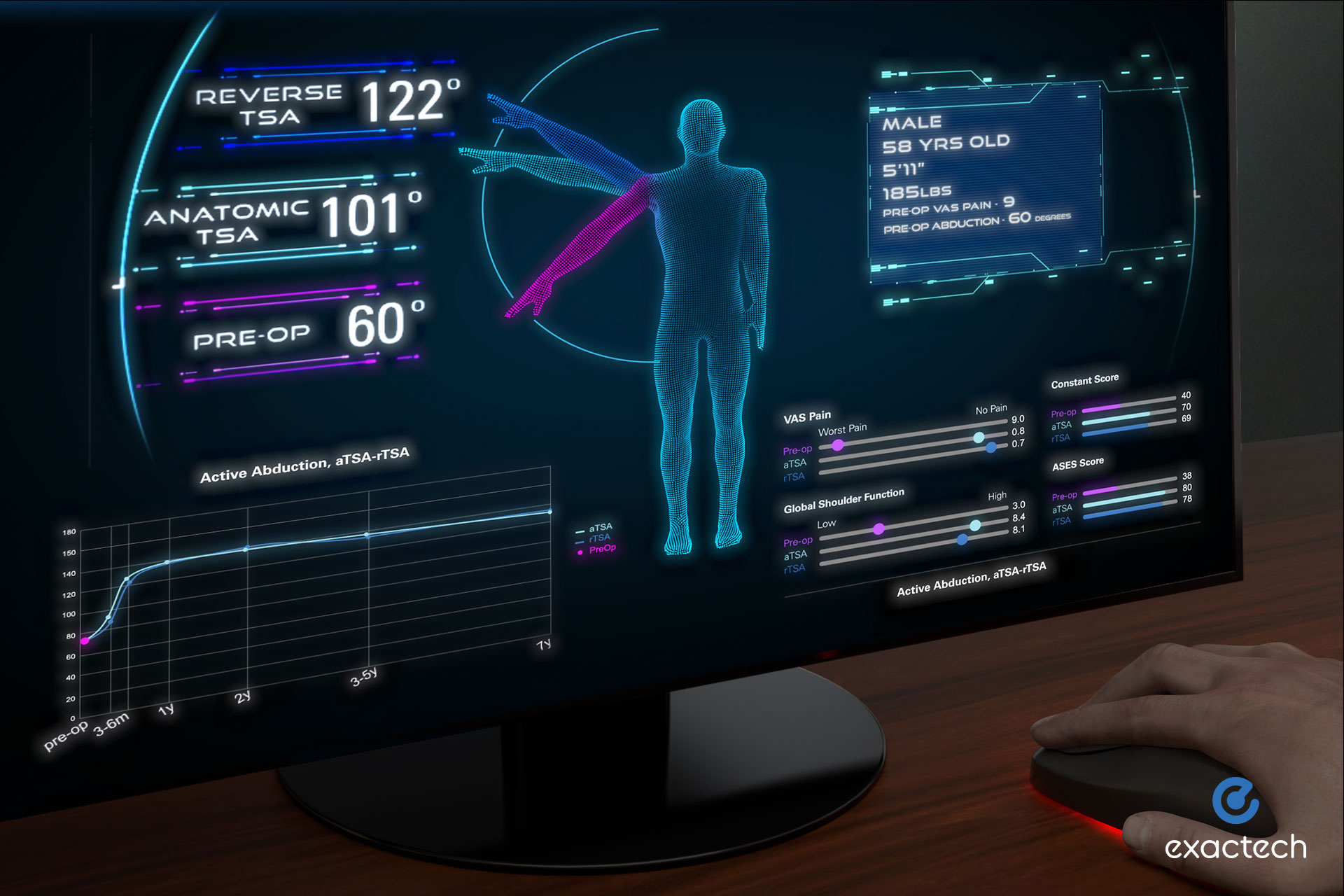 Exactech Publishes New Machine Learning Research That Evaluates ...