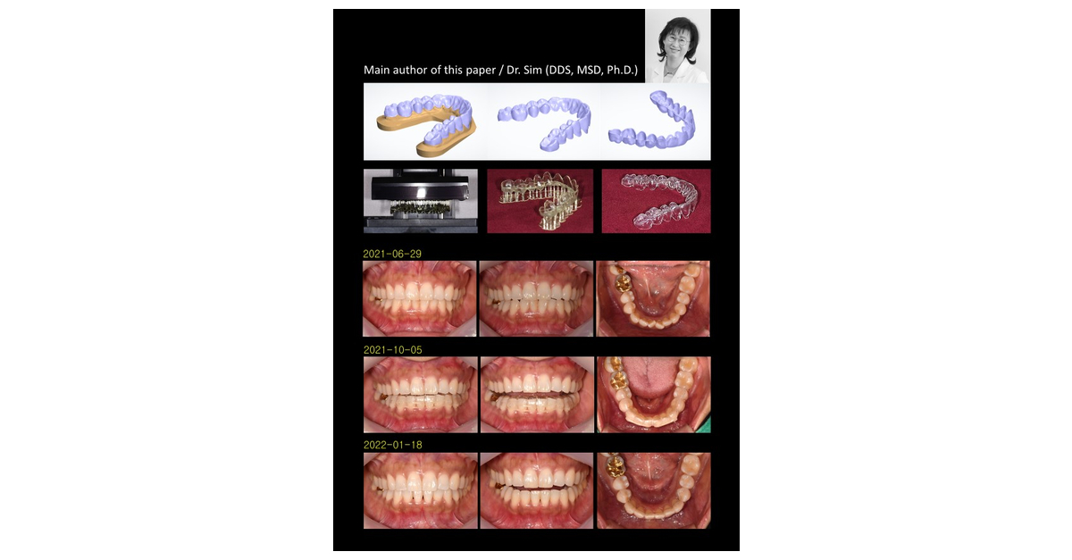 Riassunto: "AlignMiracle" fa scalpore nell'universo di Direct Clear ...