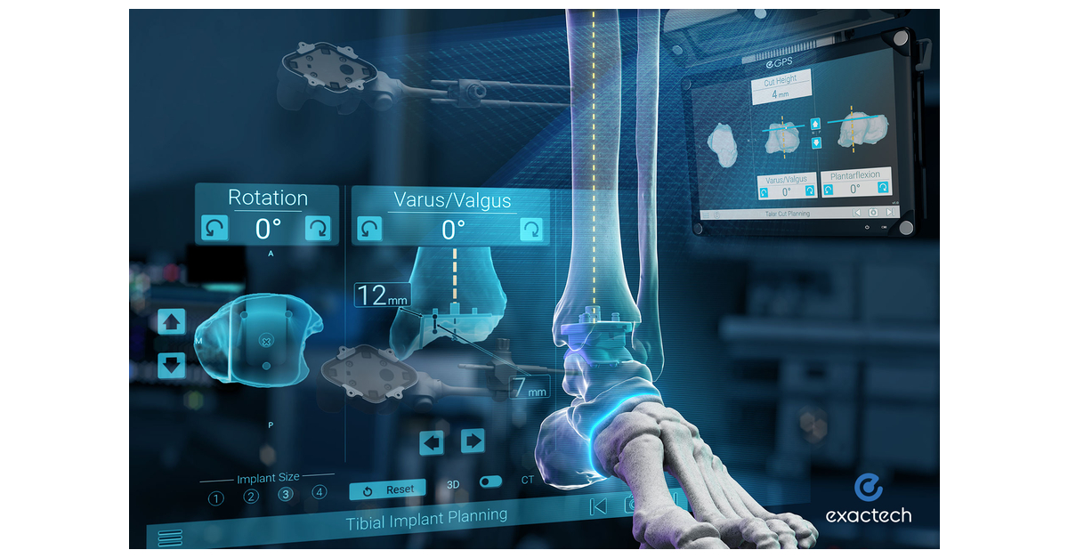 Exactech Announces FDA 510(k) Clearance of the World’s First Surgical ...