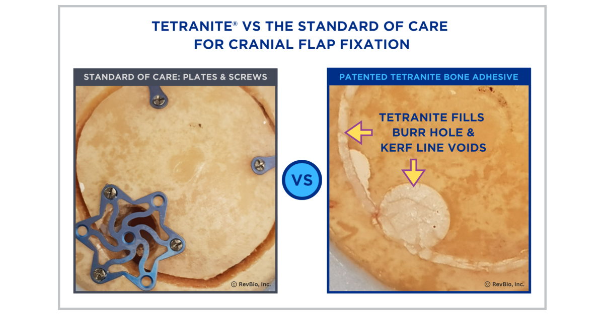RevBio Receives FDA Approval to Conduct a First-in-Human Clinical Trial ...