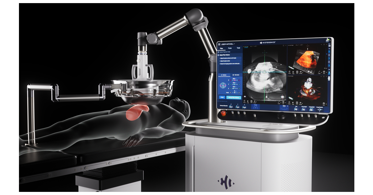 新型Edison®ヒストトリプシー・システムを用いた世界初の患者治療 | Business Wire