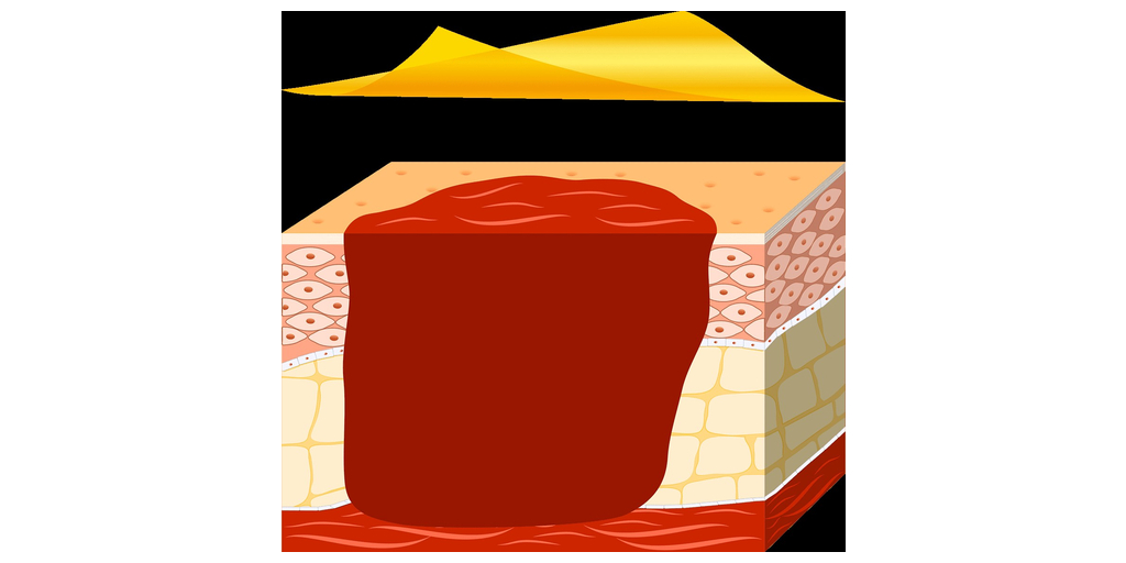 Niterra Leads $10M Growth Funding Round for Imbed Biosciences