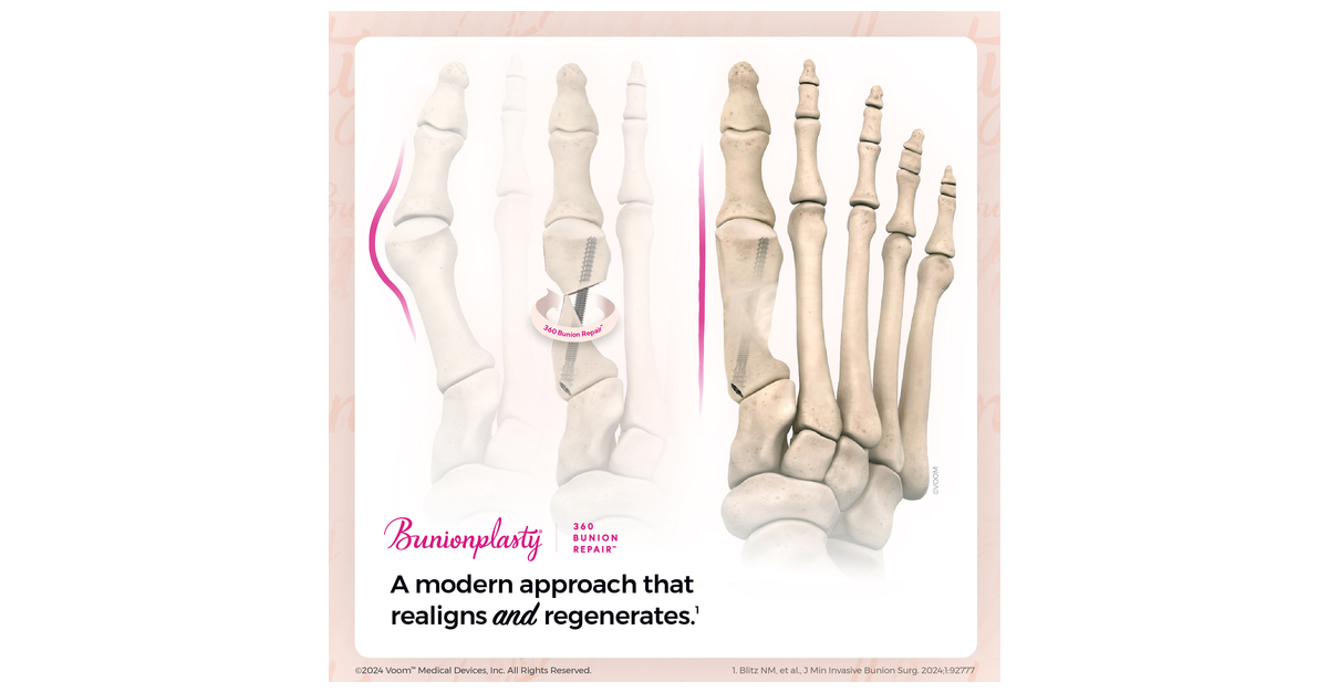 Voom™ Medical Devices’ Bunionplasty® 360 Bunion Repair™ Solution Offers ...