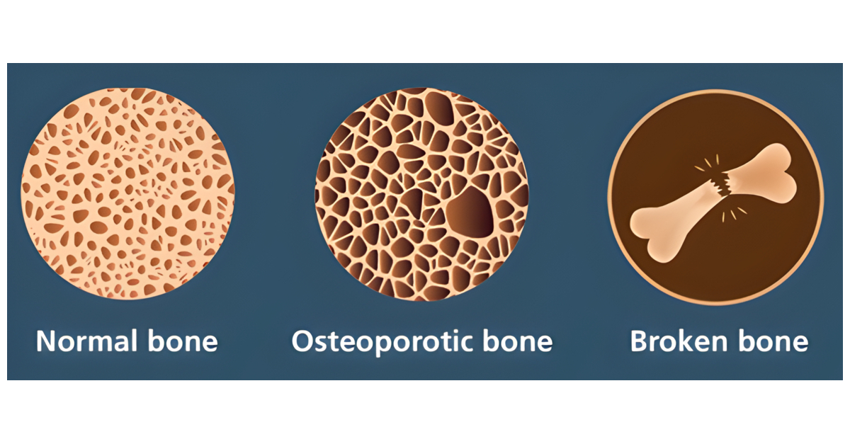 NIH-Funded Study Shows BDI's Bone Density Test Using Existing CT Images ...