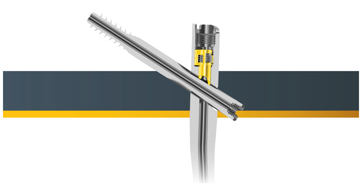 First European Surgeries Completed Using Stryker’s Gamma4 Hip Fracture ...