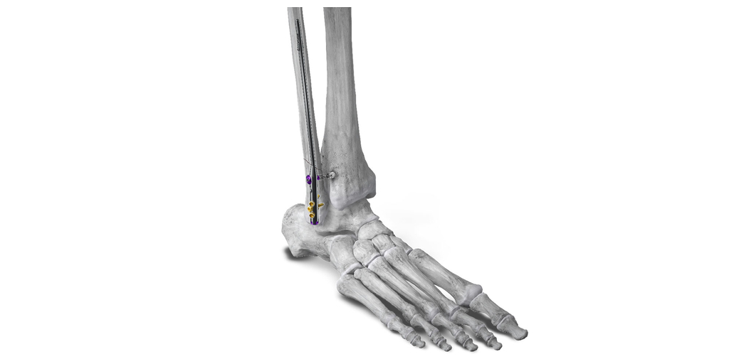 Paragon 28 Launches the Phantom® Fibula Nail System for Less Invasive ...