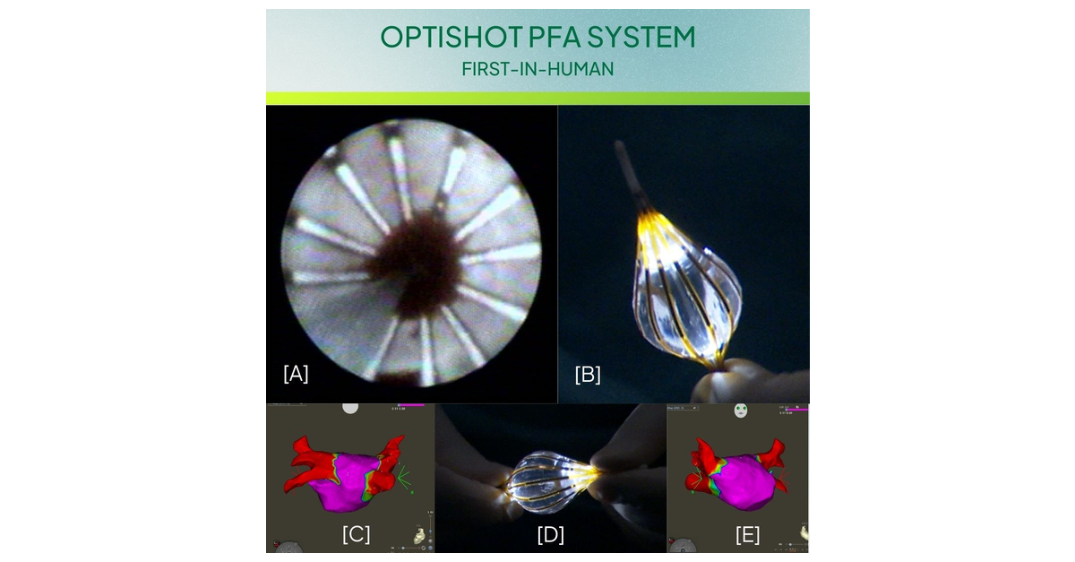 CardioFocus Announces First Patients Treated with OptiShot™ Pulsed ...