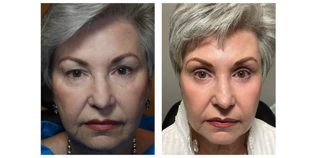 Dr. Adam Scheiner Named “Best Surgical Facial Rejuvenation” at AMWC ...