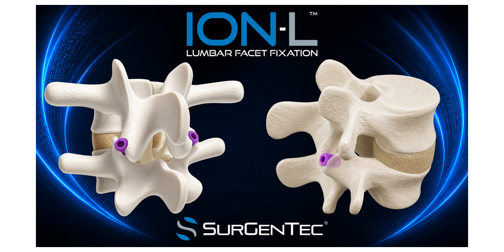 SurGenTec® Receives FDA Clearance for ION-L™, a Novel Lumbar Facet ...