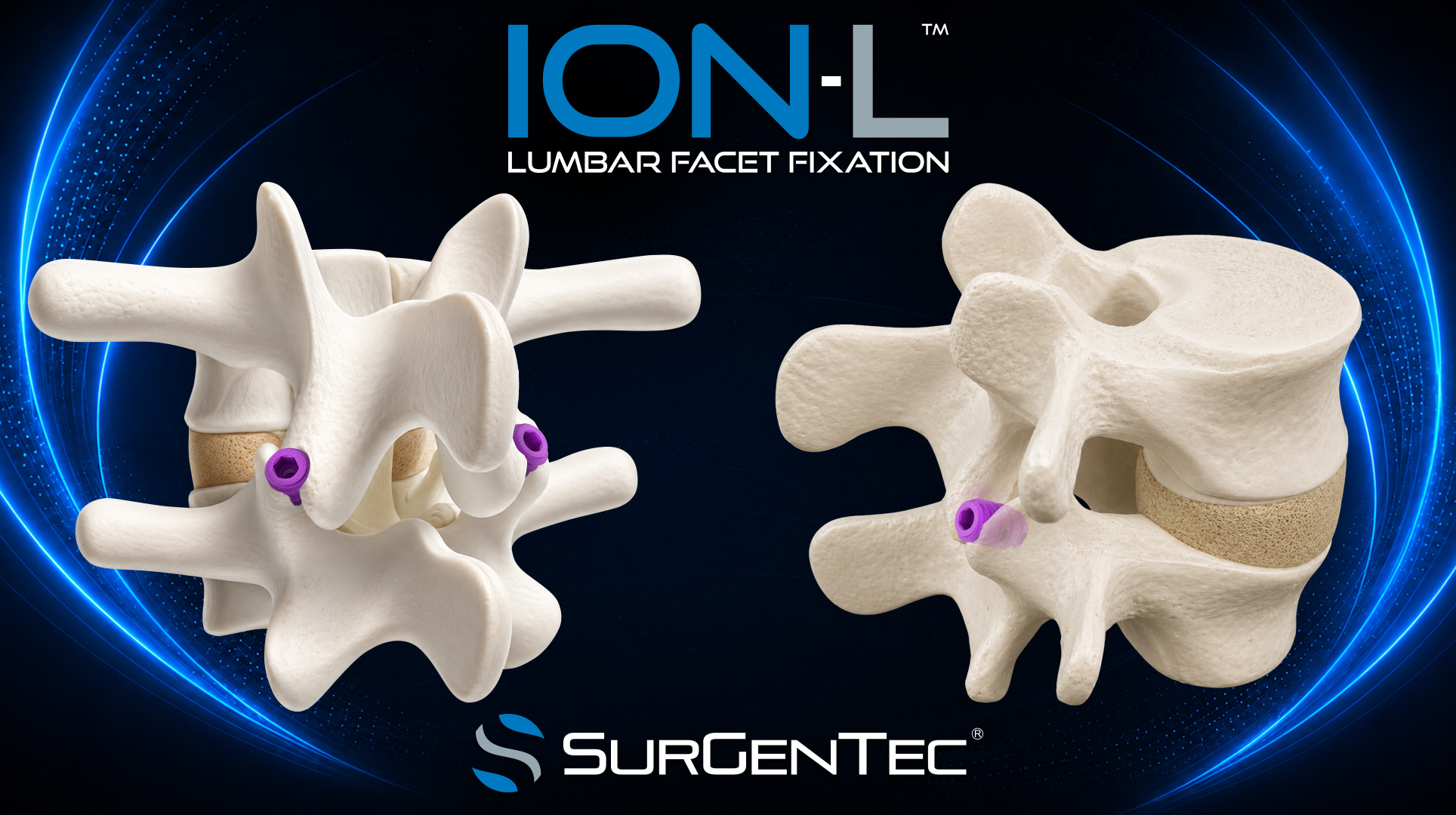 SurGenTec® Receives FDA Clearance for ION-L™, a Novel Lumbar Facet ...